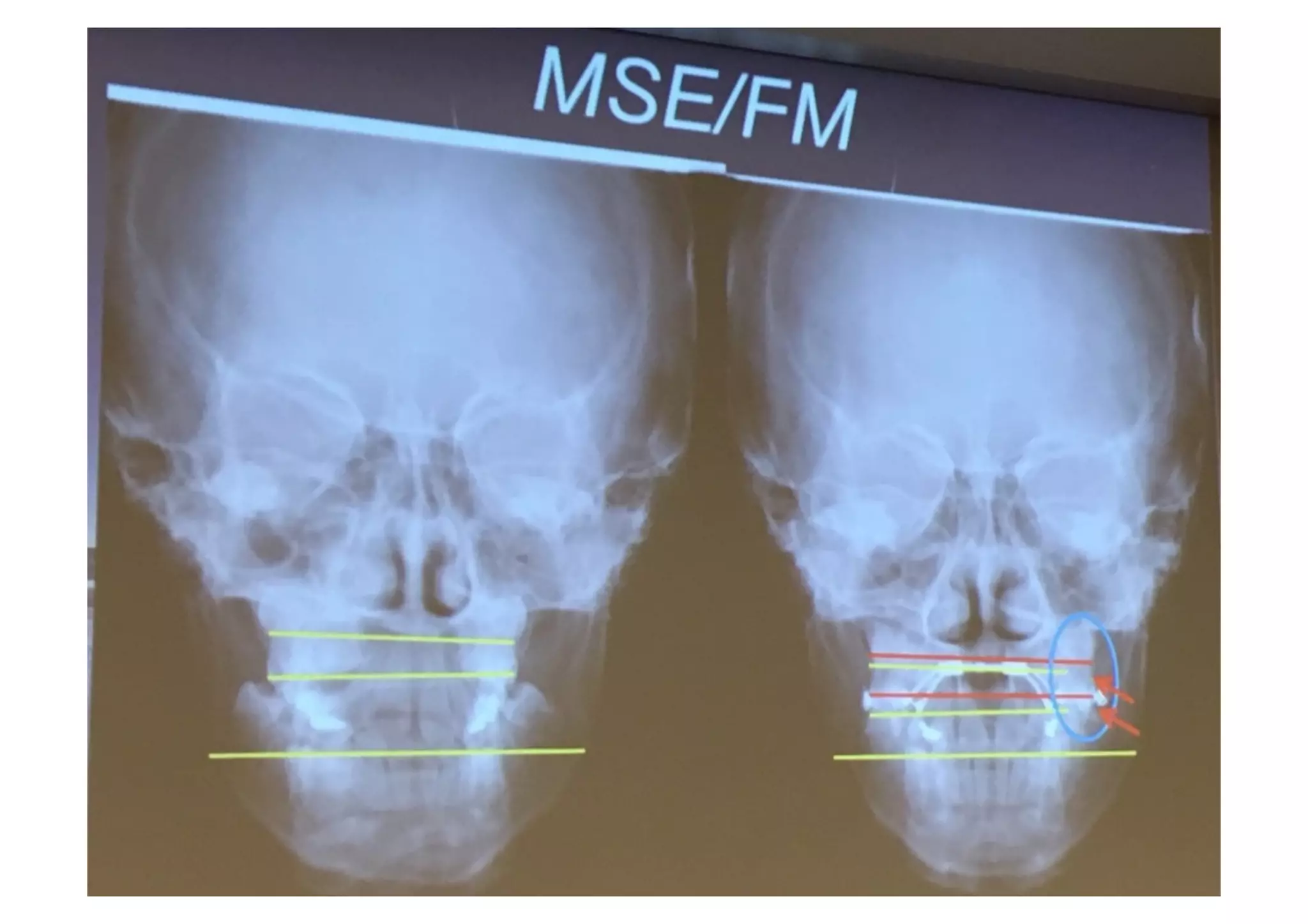 Non-Surgical Mid-Facial Expansion with Micro-Implant Assisted Maxillary ...