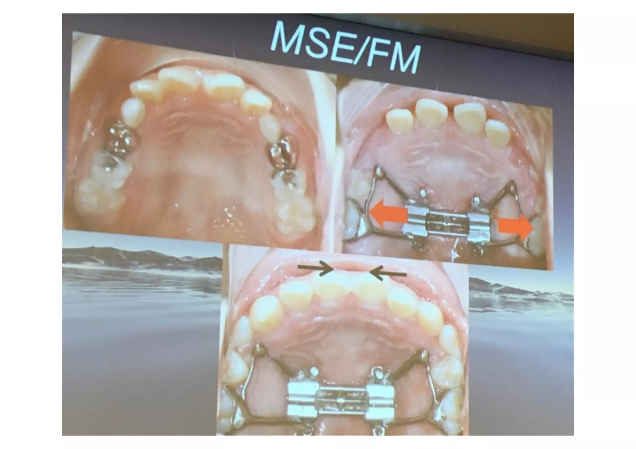 Non-Surgical Mid-Facial Expansion with Micro-Implant Assisted Maxillary ...