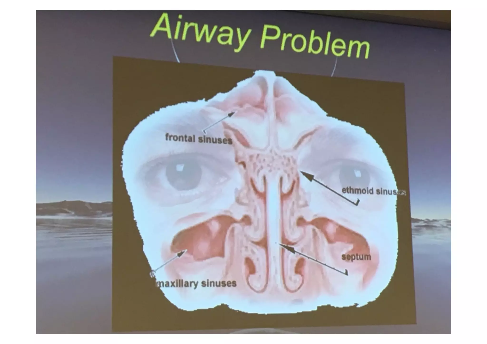 Non-Surgical Mid-Facial Expansion with Micro-Implant Assisted Maxillary ...