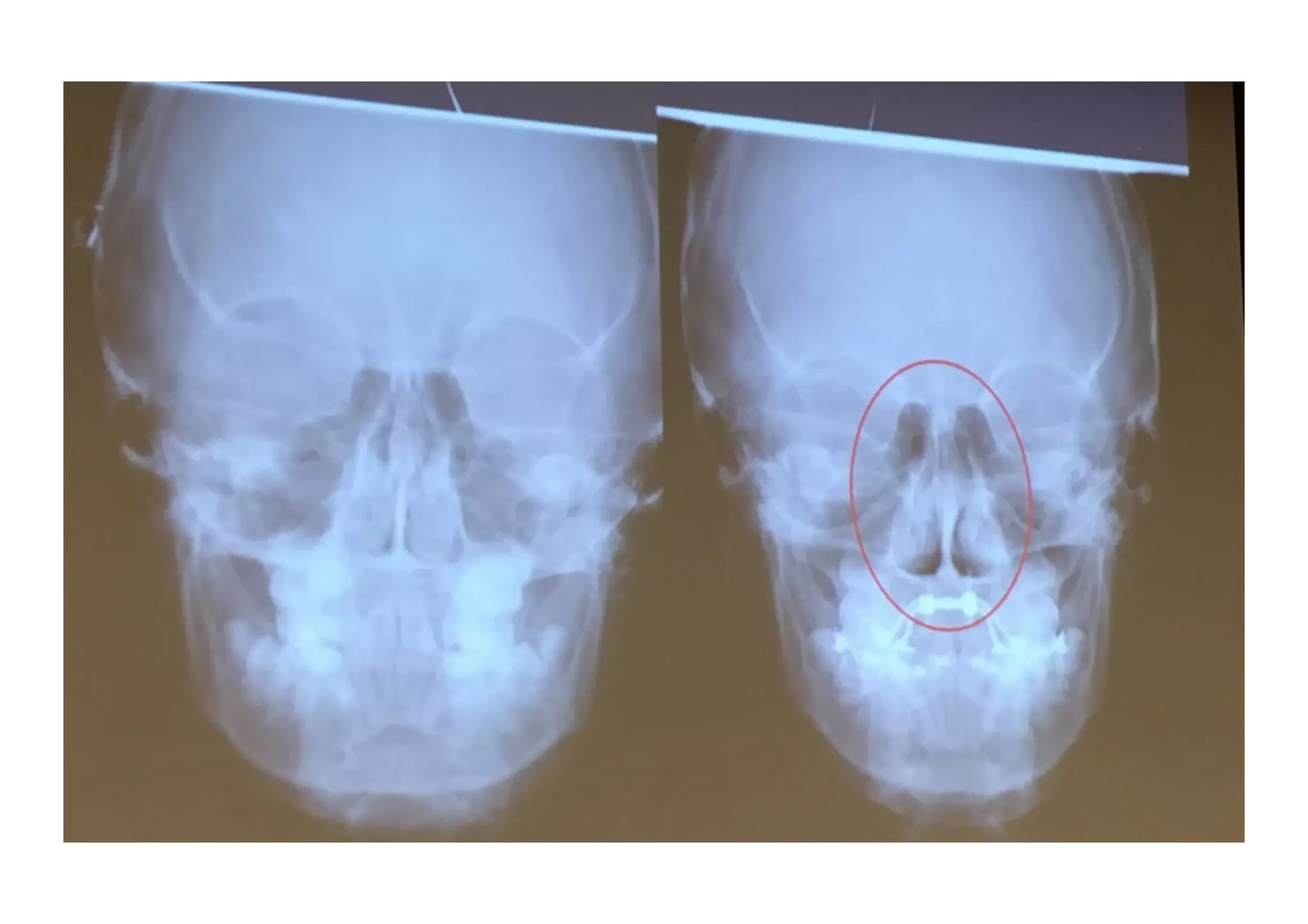 Non-Surgical Mid-Facial Expansion with Micro-Implant Assisted Maxillary ...