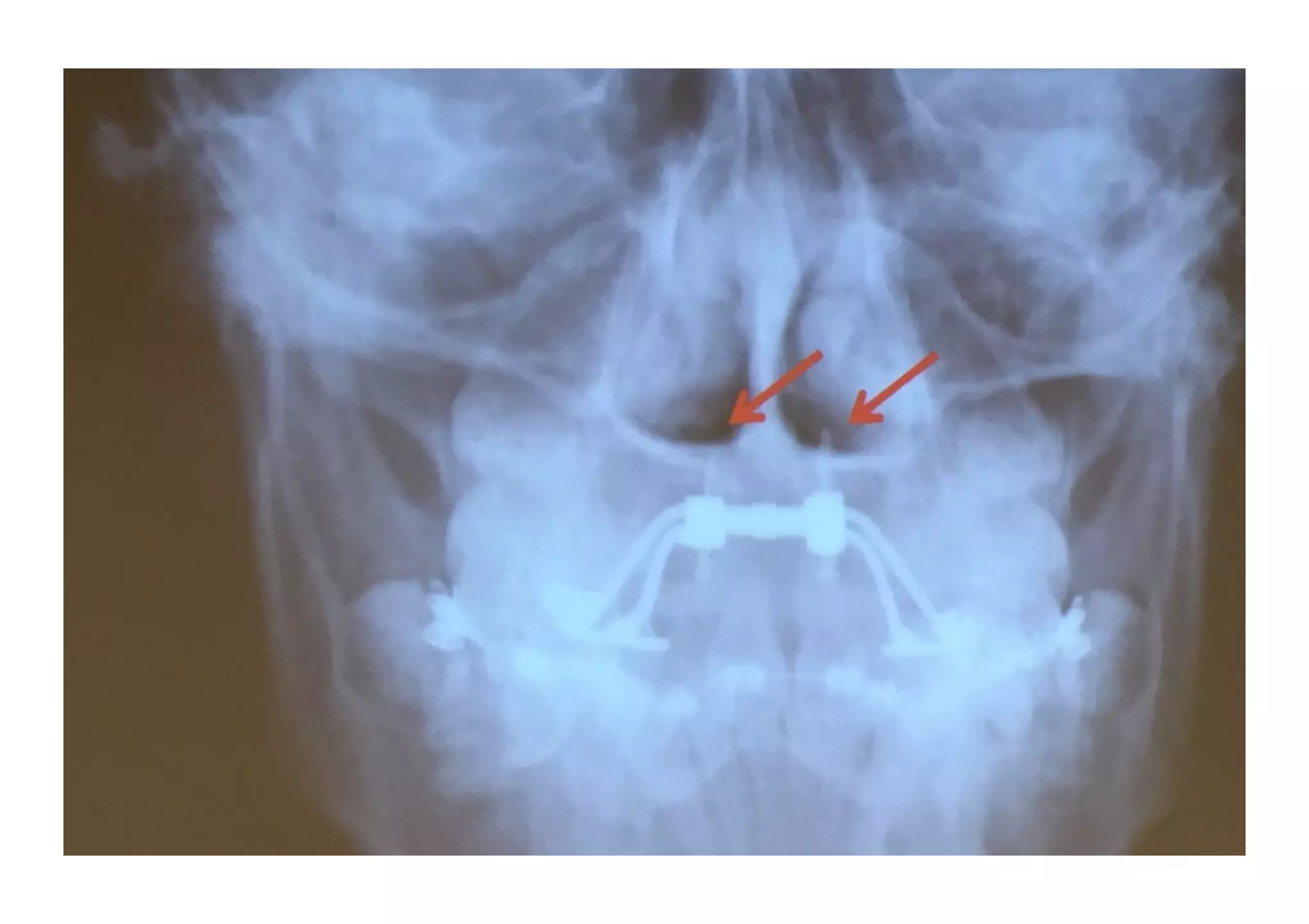 Non-Surgical Mid-Facial Expansion with Micro-Implant Assisted Maxillary ...