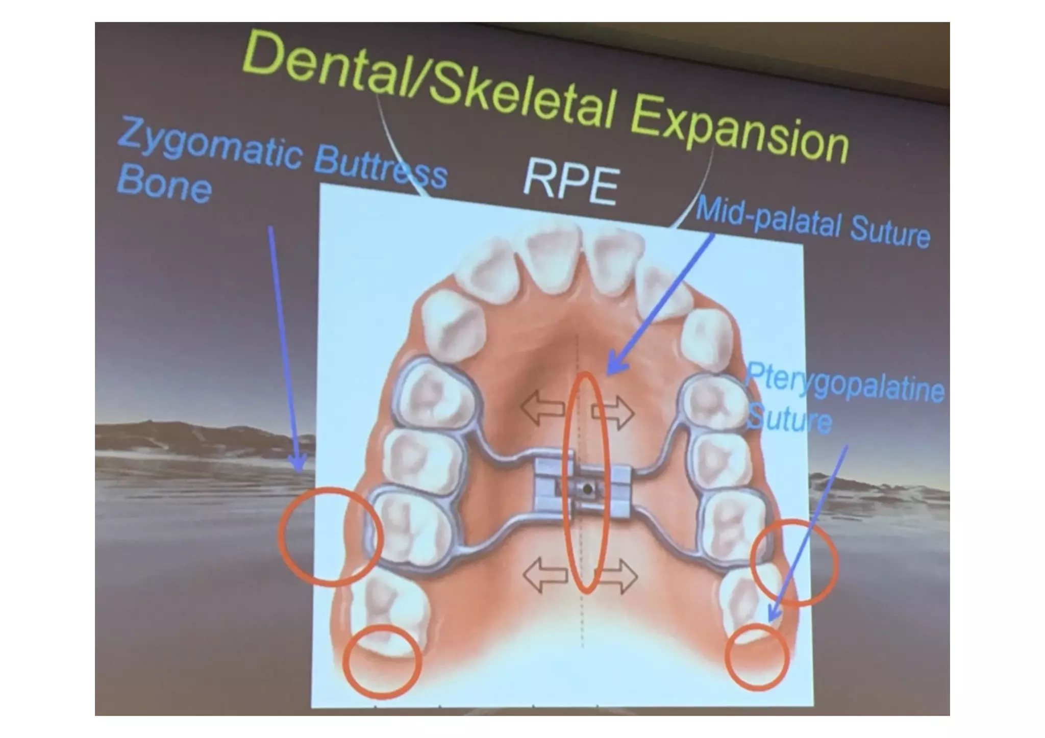 Non-Surgical Mid-Facial Expansion with Micro-Implant Assisted Maxillary ...