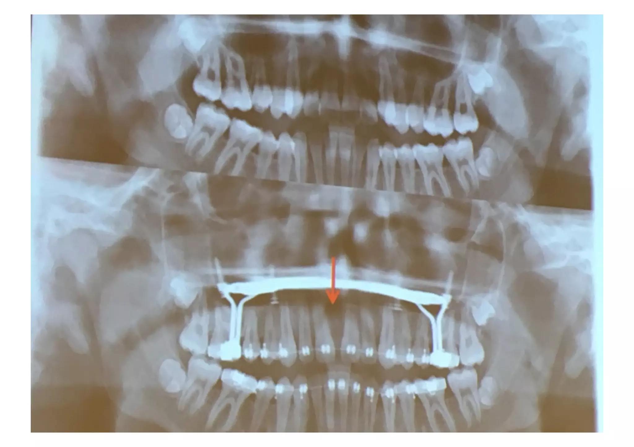 Non-Surgical Mid-Facial Expansion with Micro-Implant Assisted Maxillary ...