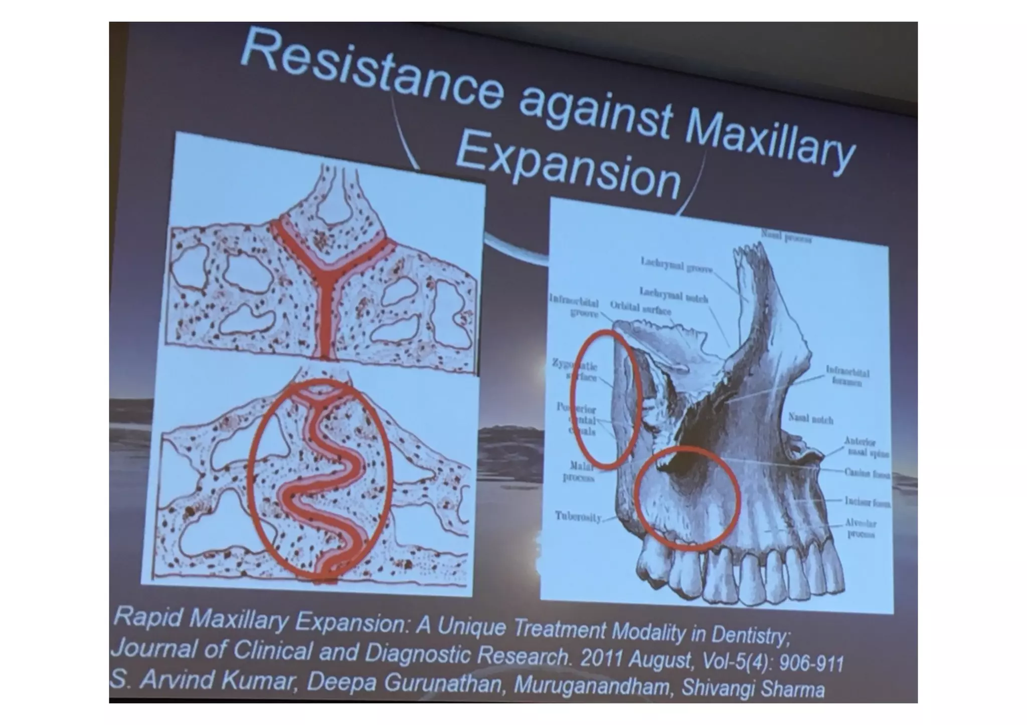 Non-Surgical Mid-Facial Expansion with Micro-Implant Assisted Maxillary ...