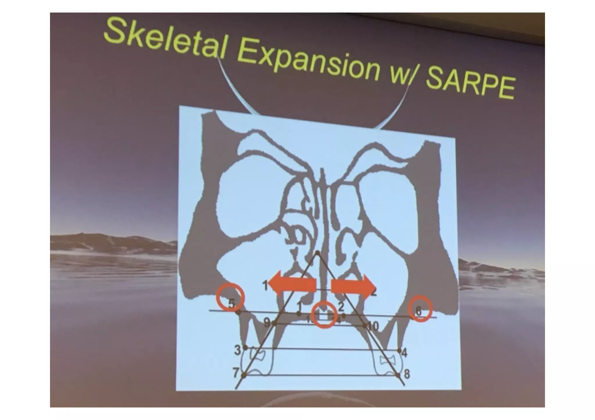 Non-Surgical Mid-Facial Expansion with Micro-Implant Assisted Maxillary ...