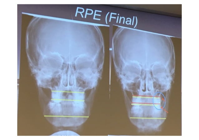 Non-Surgical Mid-Facial Expansion with Micro-Implant Assisted Maxillary ...