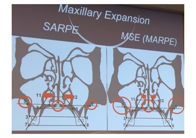 Non-Surgical Mid-Facial Expansion with Micro-Implant Assisted Maxillary ...