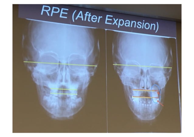 Non-Surgical Mid-Facial Expansion with Micro-Implant Assisted Maxillary ...
