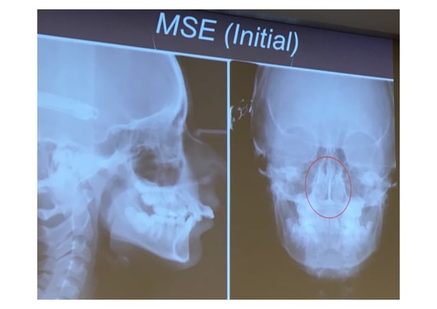 Non-Surgical Mid-Facial Expansion with Micro-Implant Assisted Maxillary ...