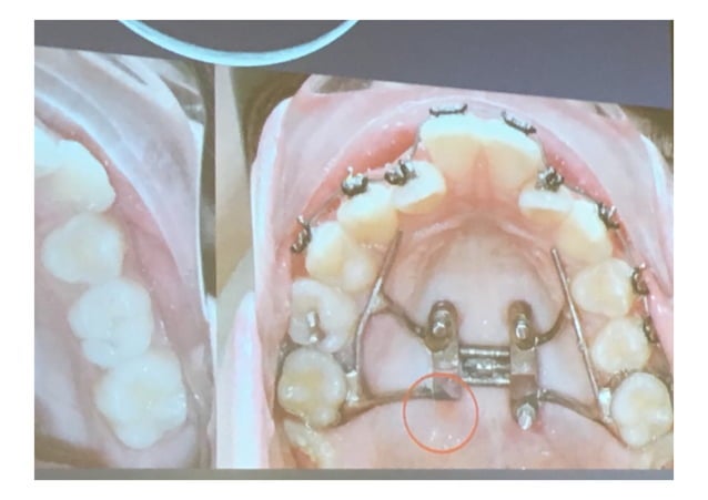 Non-Surgical Mid-Facial Expansion with Micro-Implant Assisted Maxillary ...
