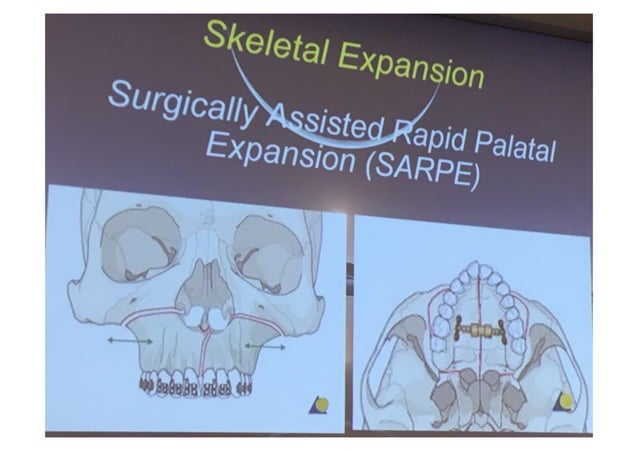 Non-Surgical Mid-Facial Expansion with Micro-Implant Assisted Maxillary ...