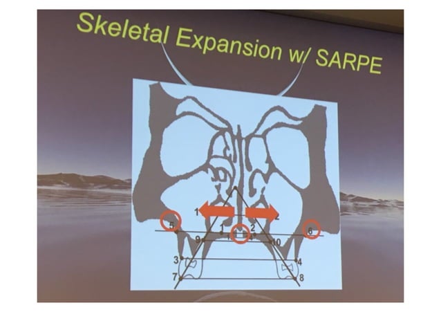 Non-Surgical Mid-Facial Expansion with Micro-Implant Assisted Maxillary ...