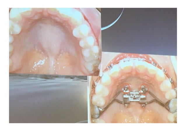 Non-Surgical Mid-Facial Expansion with Micro-Implant Assisted Maxillary ...