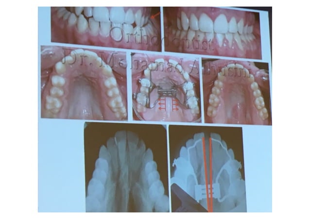 Non-Surgical Mid-Facial Expansion with Micro-Implant Assisted Maxillary ...