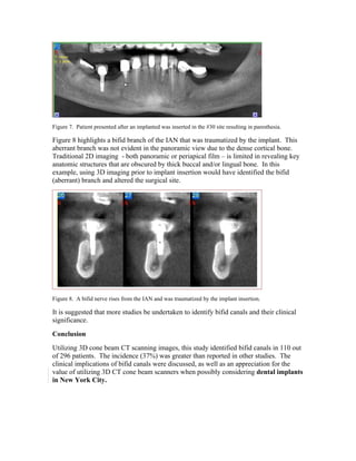 Dental 3D Cone Beam CT Imaging: Part III Bifid Canals (and other ...