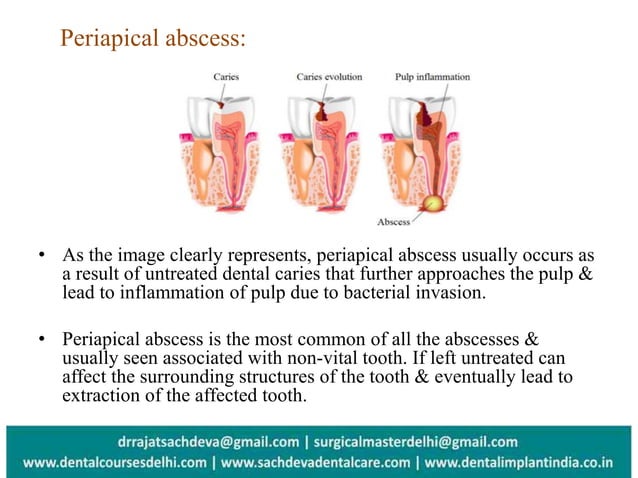 Dental Abscess | PPTX