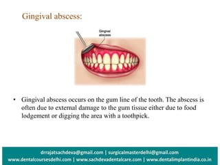 Dental Abscess | PPTX