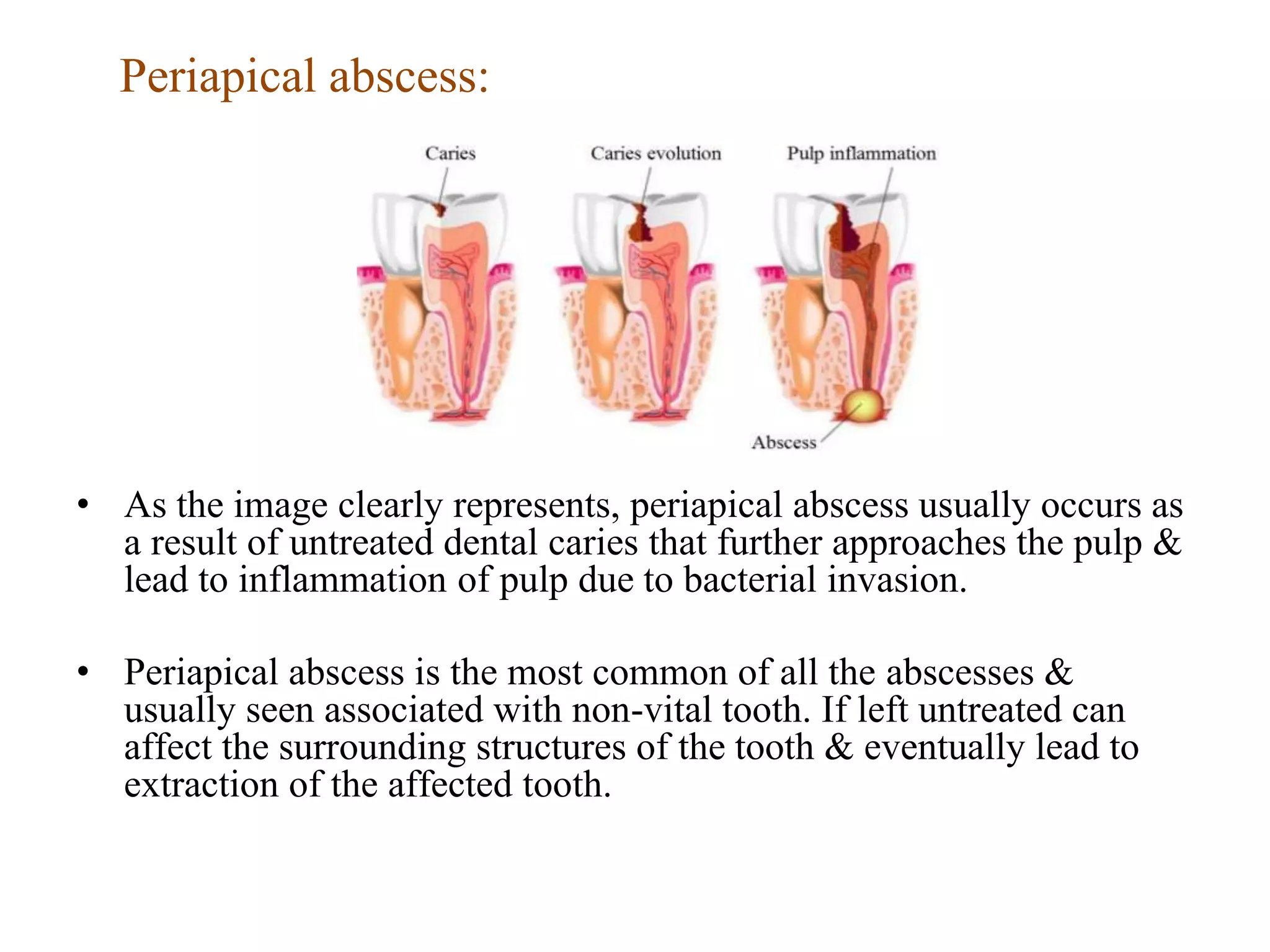 dental abscess lec.pdf