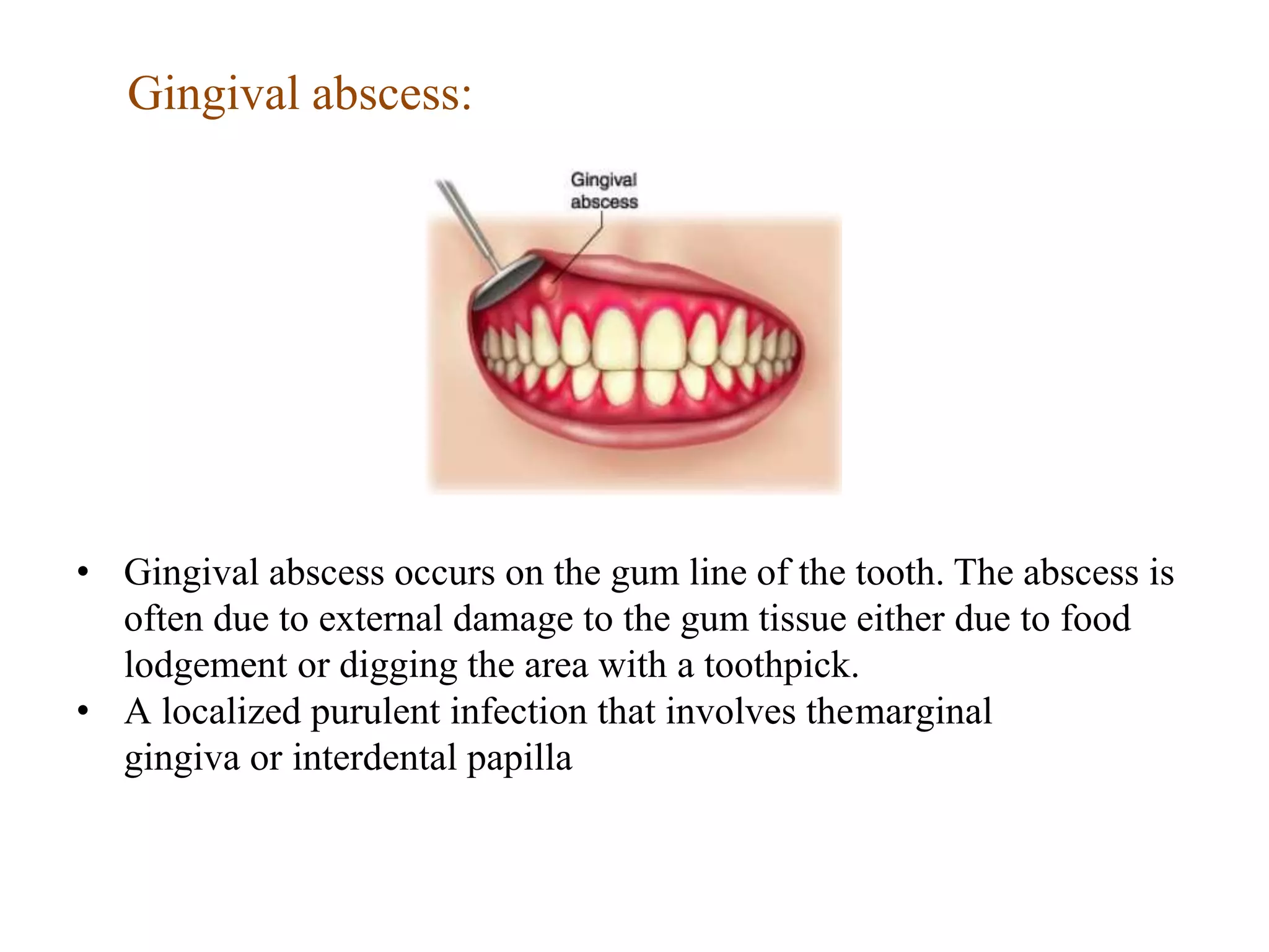 Dental Abscess Lecpdf
