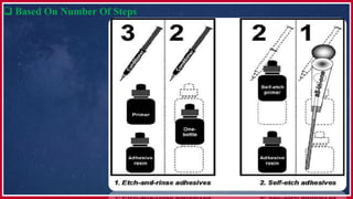 Dental adhesive system | PPTX