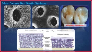 Dental adhesive system | PPTX