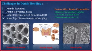 Dental adhesive system | PPTX