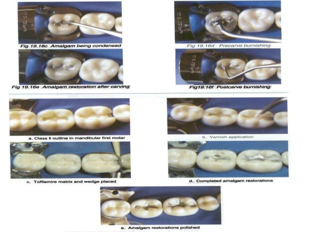 Dental amalgam | PPTX