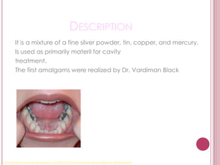 Dental amalgam | PDF