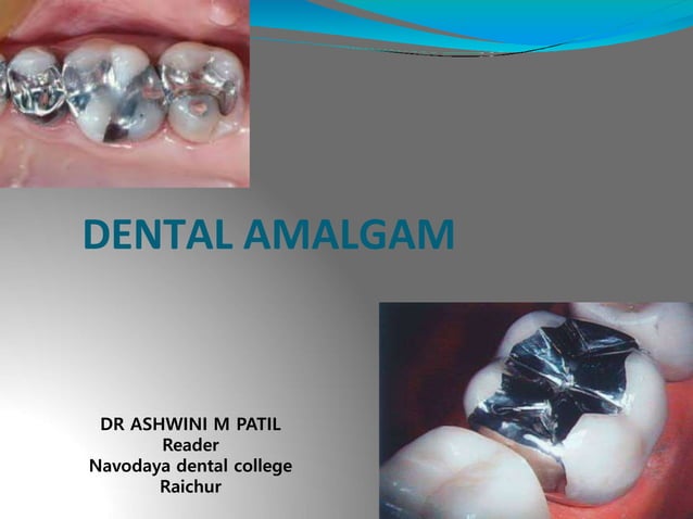 dentalamalgam.pptx