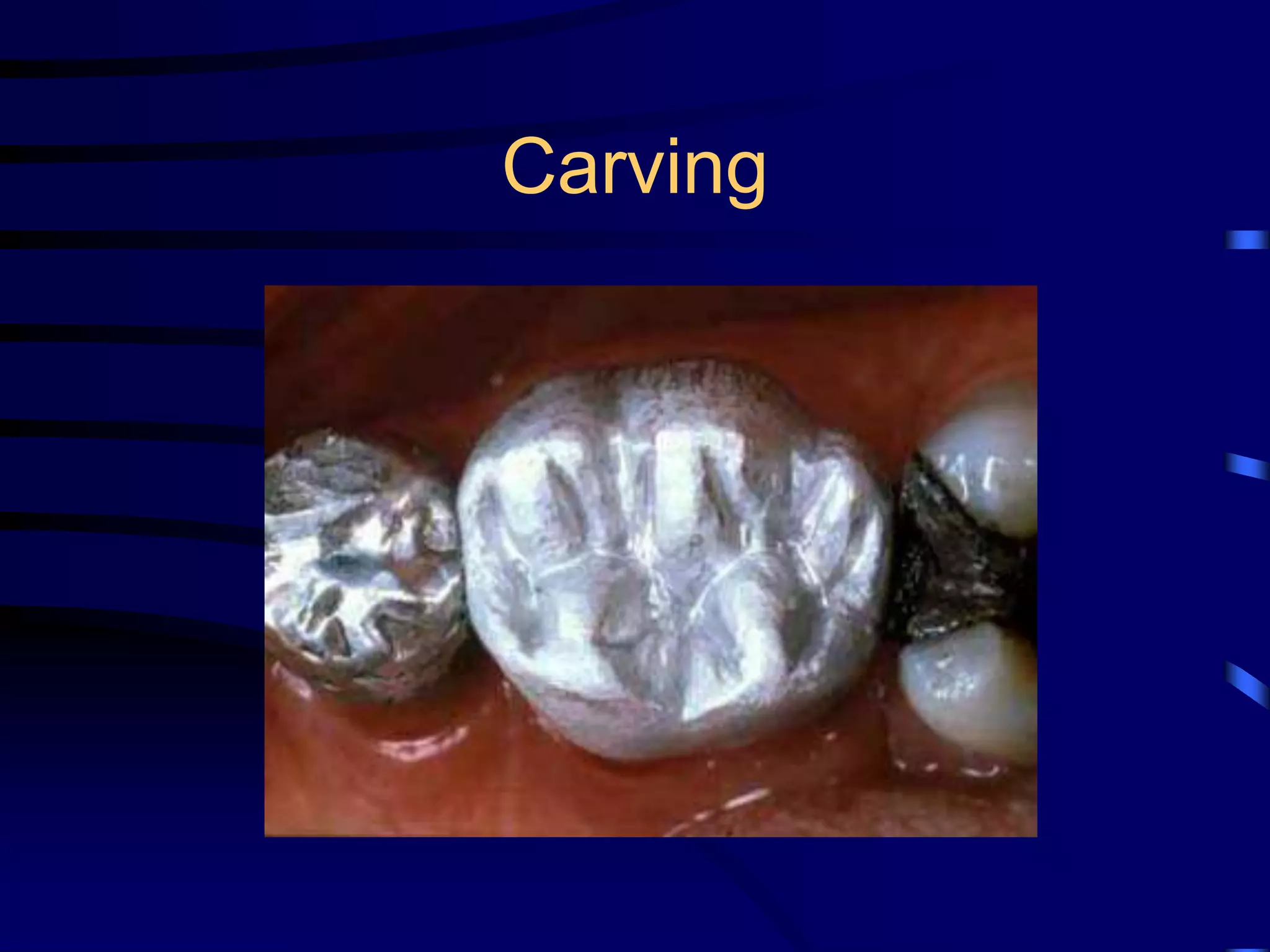 Dental amalgam - Recent advances.ppt