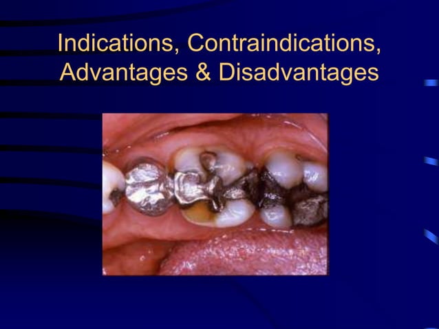 Dental amalgam - Recent advances.ppt