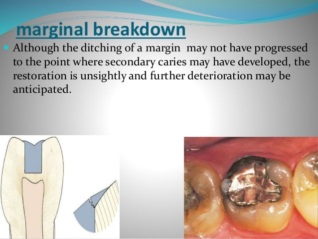 Dental amalgam power point by Dr.Kazhan O. Abdulrahman