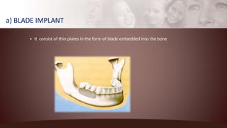 Dental and Maxillofacial Implants | PPTX