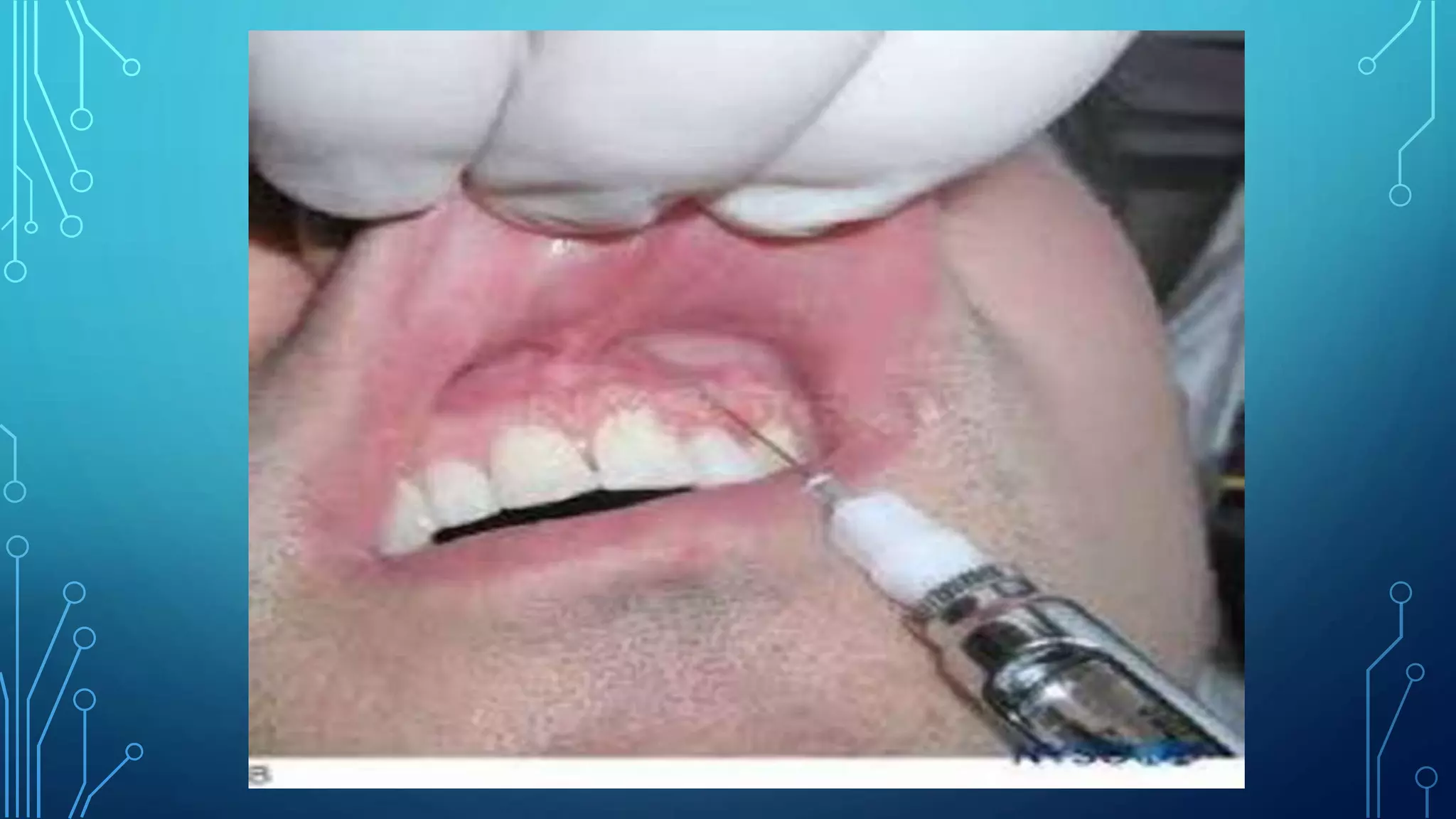 Dental Anesthesia Dental Anaesthesia Techniques & Complications | PPTX