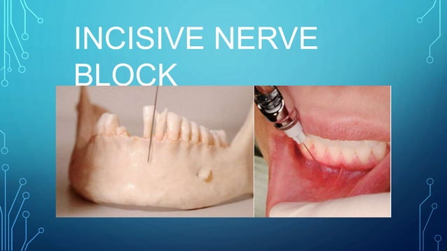 Dental Anesthesia Dental Anaesthesia Techniques & Complications | PPT