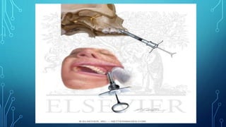 Dental Anesthesia Dental Anaesthesia Techniques & Complications | PPTX