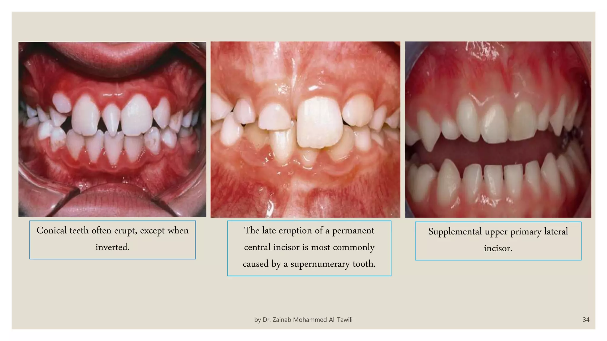 Dental anomalies | PPTX