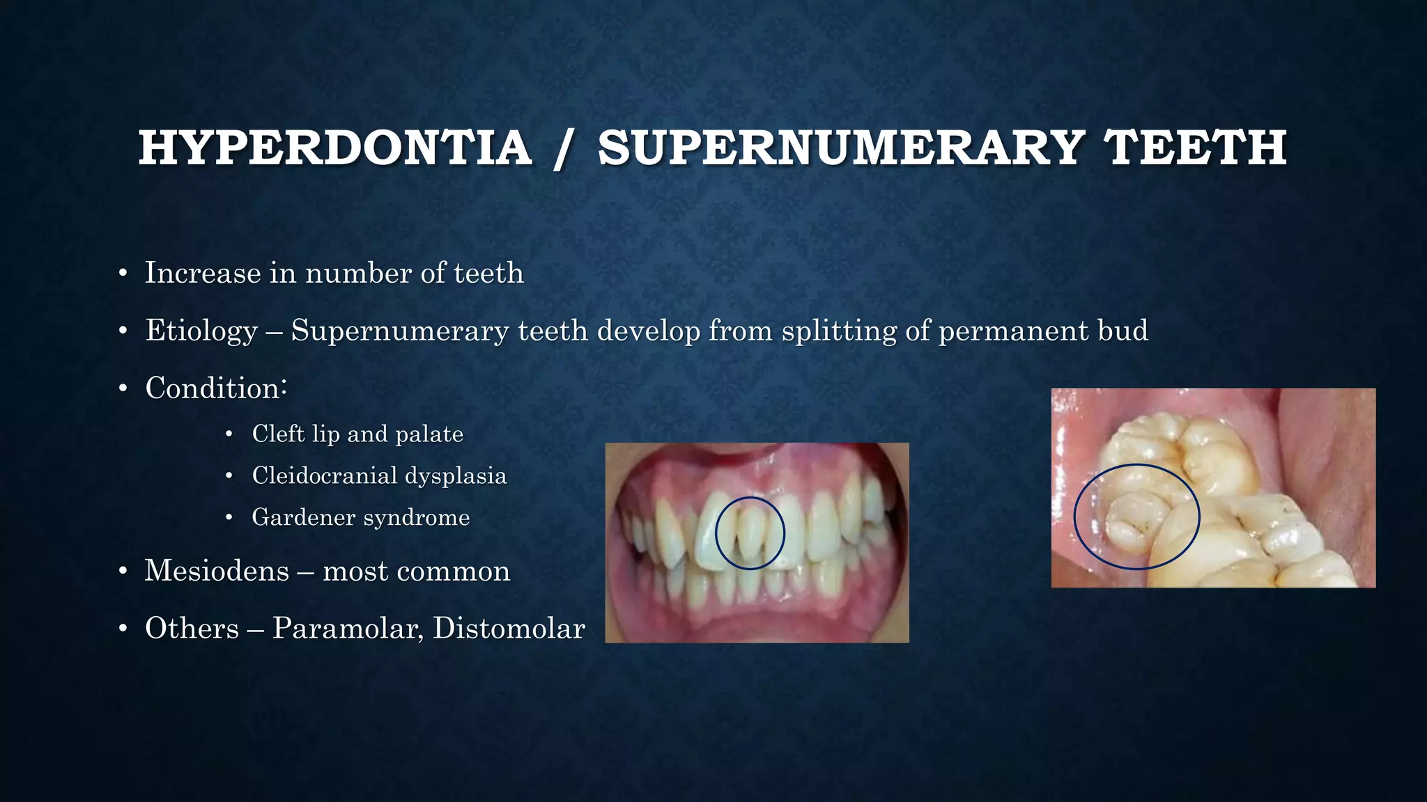 Dental anomalies and its prosthetic implications.pptx