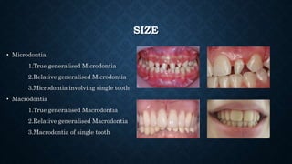 Dental anomalies and its prosthetic implications.pptx | Dental Health ...