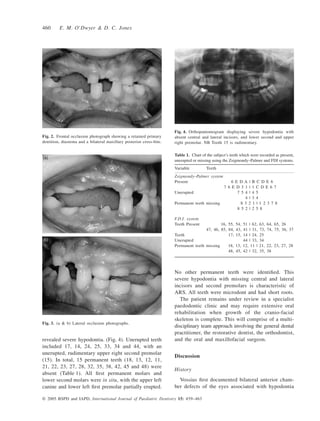 Dental anomalies in axenfeld rieger syndrome (1) | PDF
