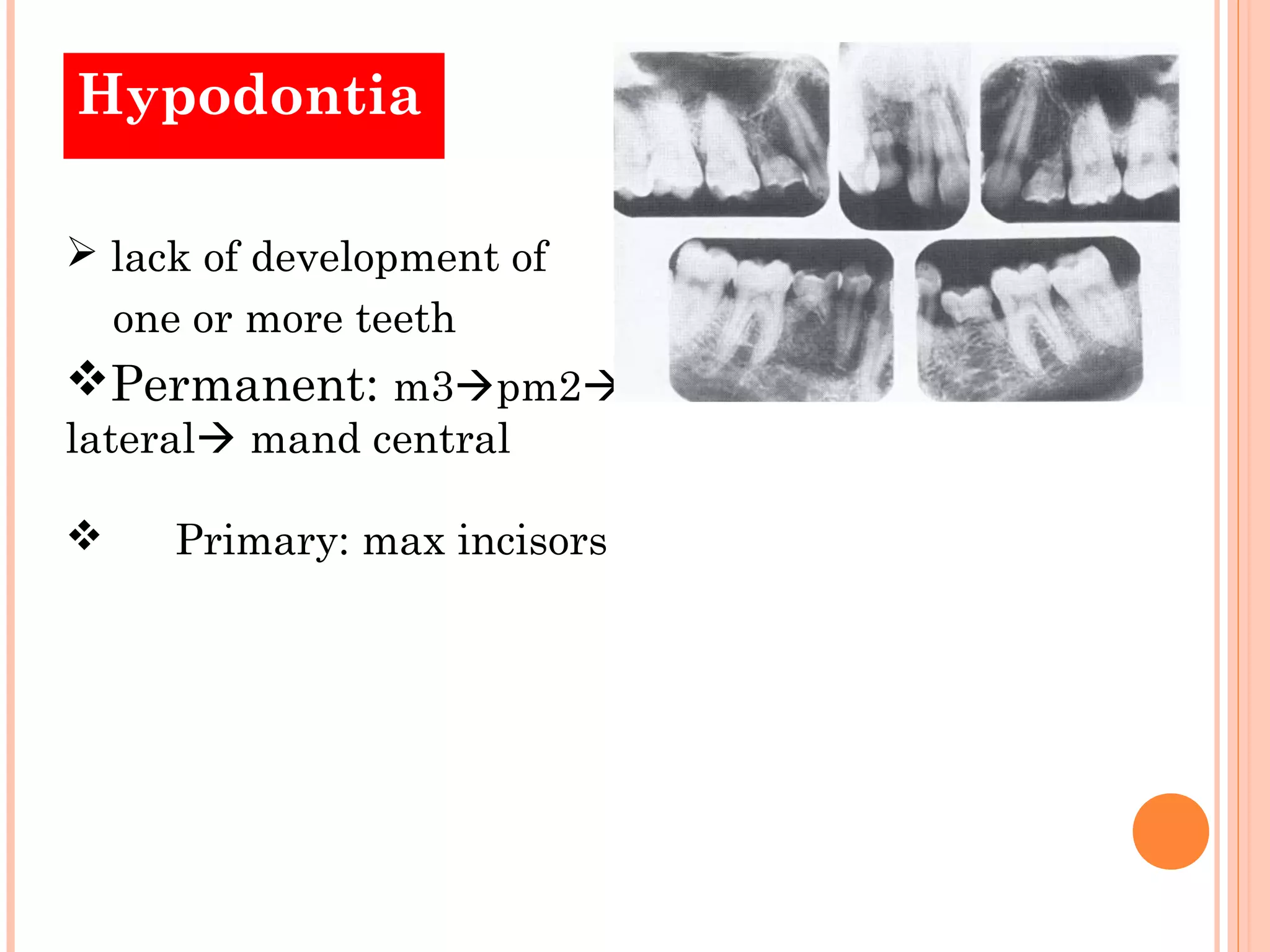 Dental anomaly | PPT