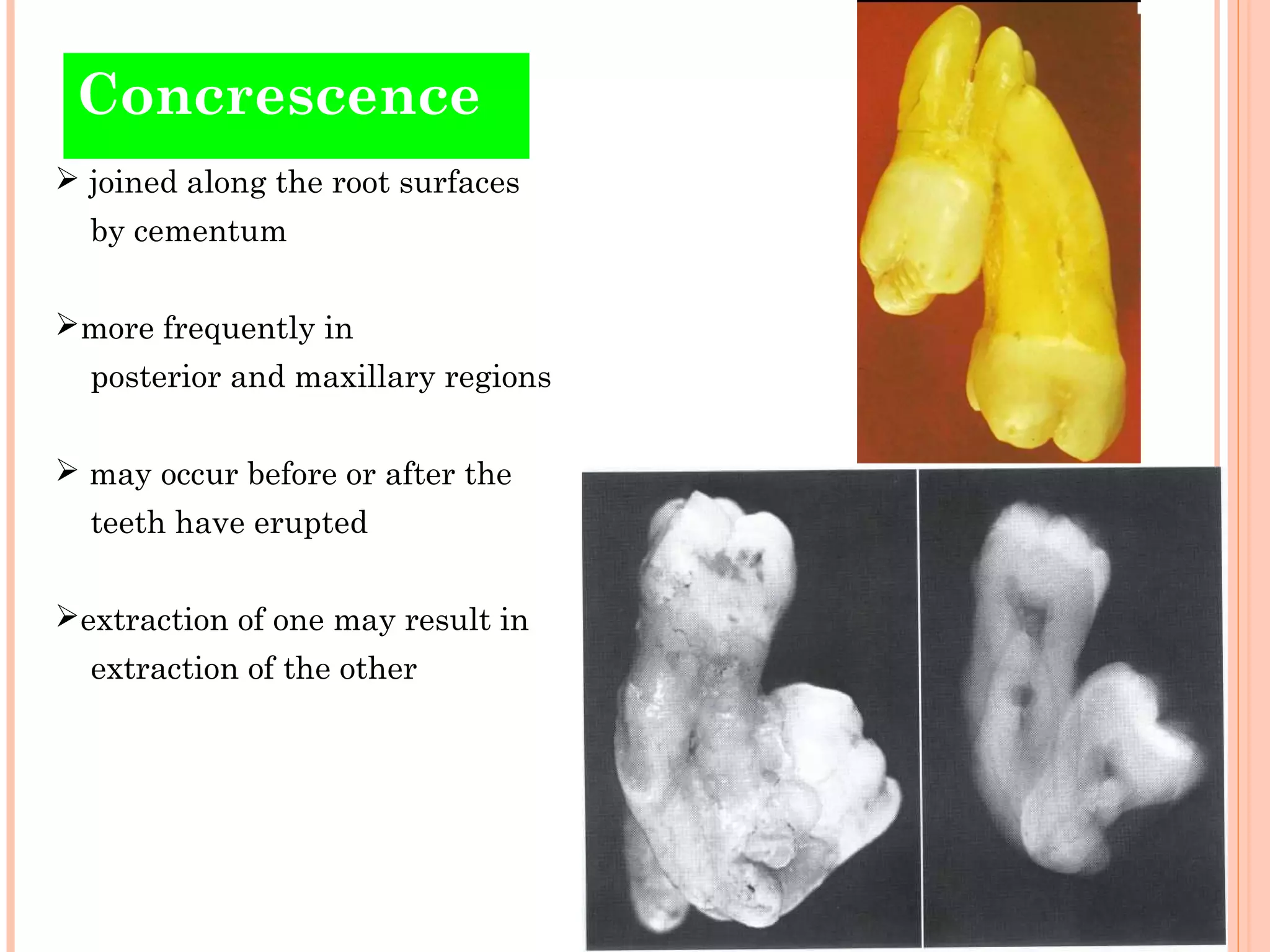 Dental anomaly | PPT