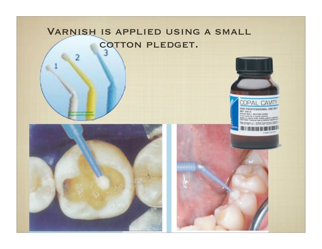 Dental bases and liners | PDF | Dental Health | Diseases and Conditions