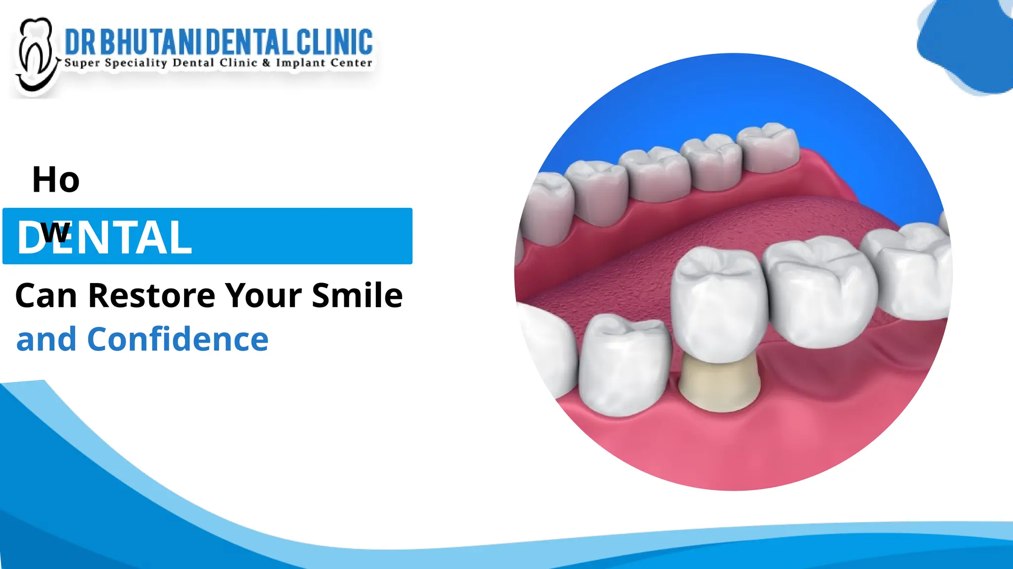 How Dental Bridges Can Restore Your Smile and Confidence? | PPT