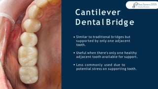 Dental Bridges And It's Types Explained Simply | PPTX