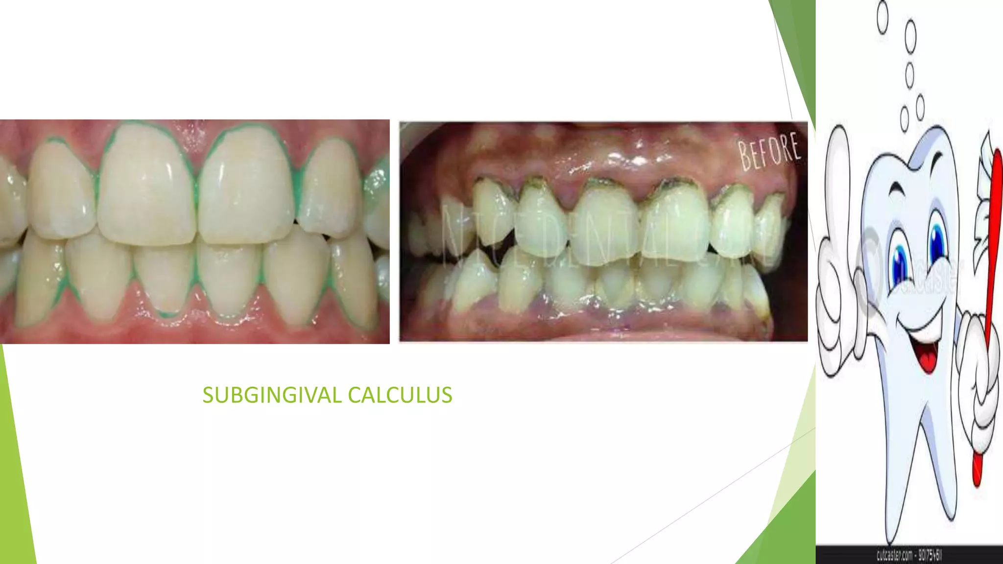 Dental calculus | PPTX