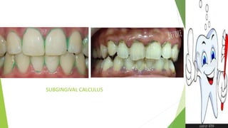 Dental calculus | PPTX