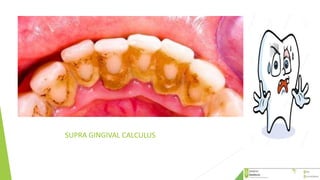 Dental calculus | PPTX