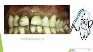 Dental calculus | PPTX