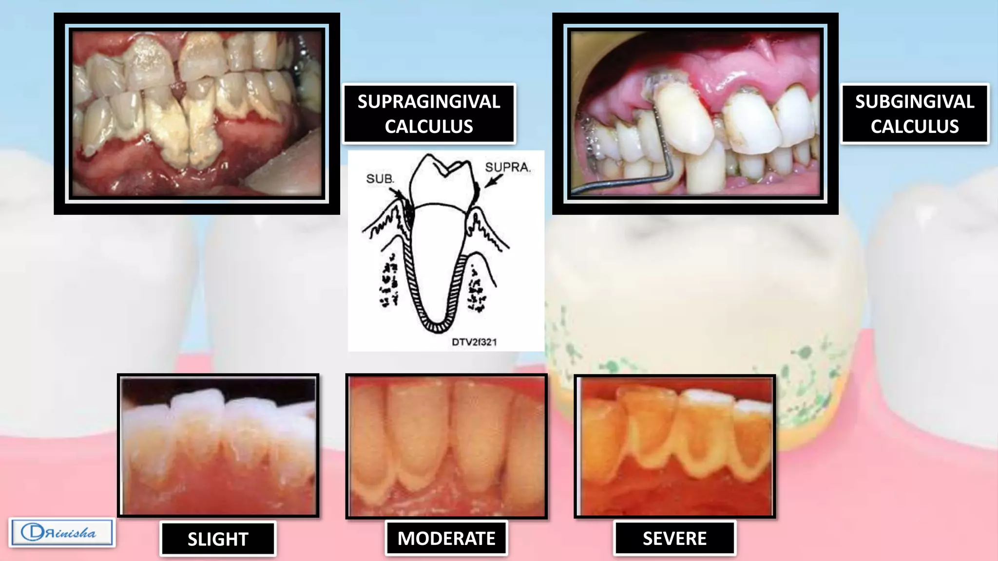 Dental calculus | PPTX